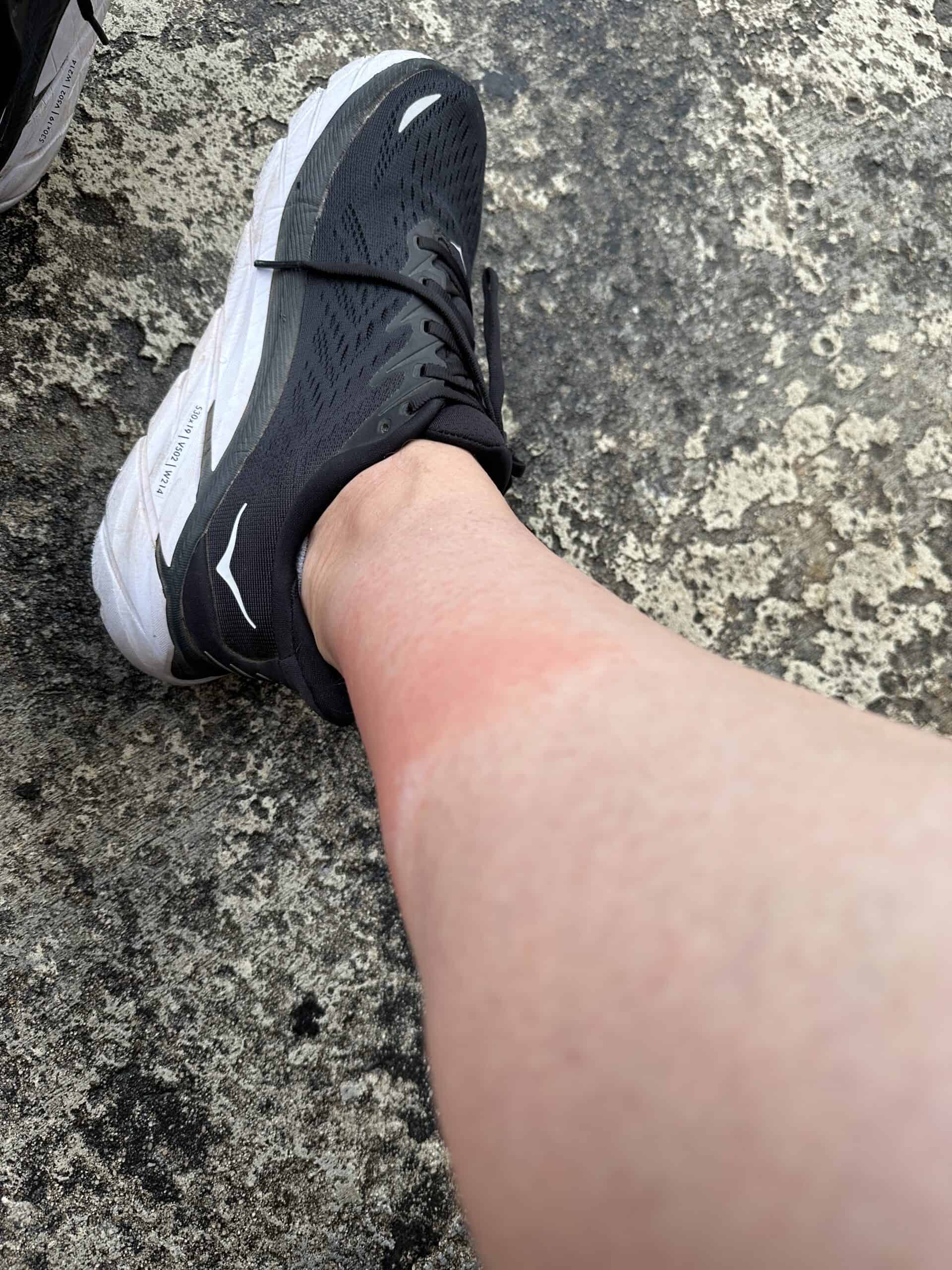 The Disney Rash Is Real! How to avoid and treat it.